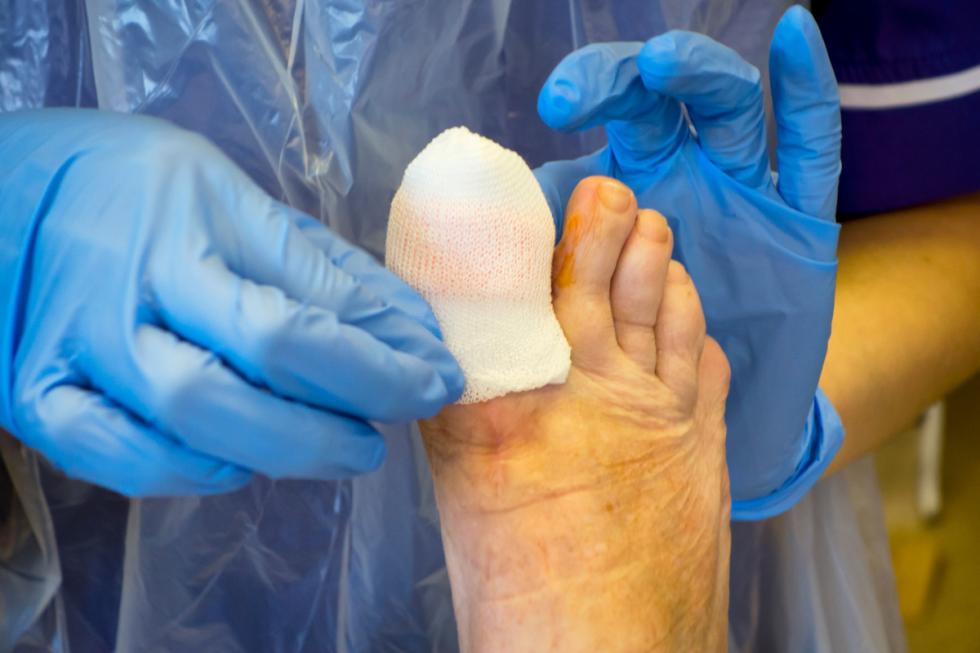 Cómo tratar las uñas encarnadas de manera efectiva - Clinica del pie ...